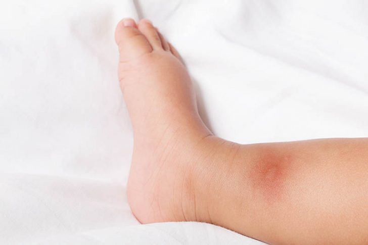 Mosquito Bites On Babies: The Best Ways To Manage The Menace